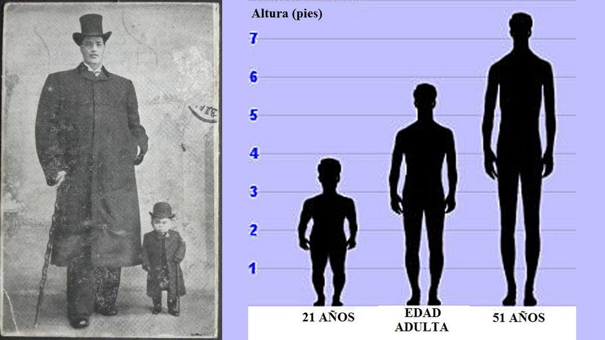 La increíble historia de Adam Rainer, el único ser humano que ha ...